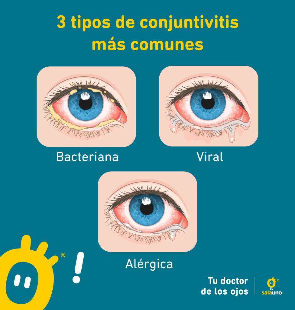 Conjuntivitis: Síntomas y tratamiento - salauno