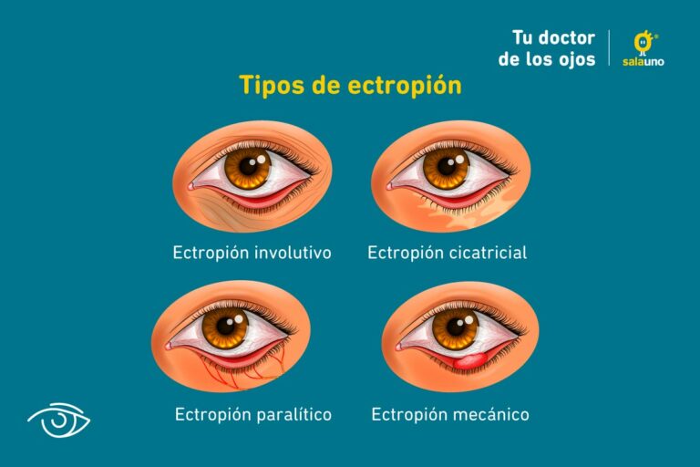 Entropión y ectropión: Diferencias, causas y tratamiento - salauno